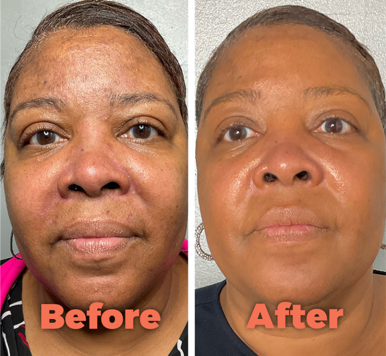 What's a Vi Peel? Your Questions Answered by a Professional : The Sway